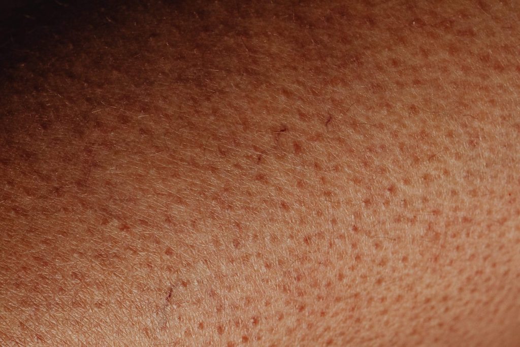 How To Get Rid of Strawberry Legs - BeFashionable